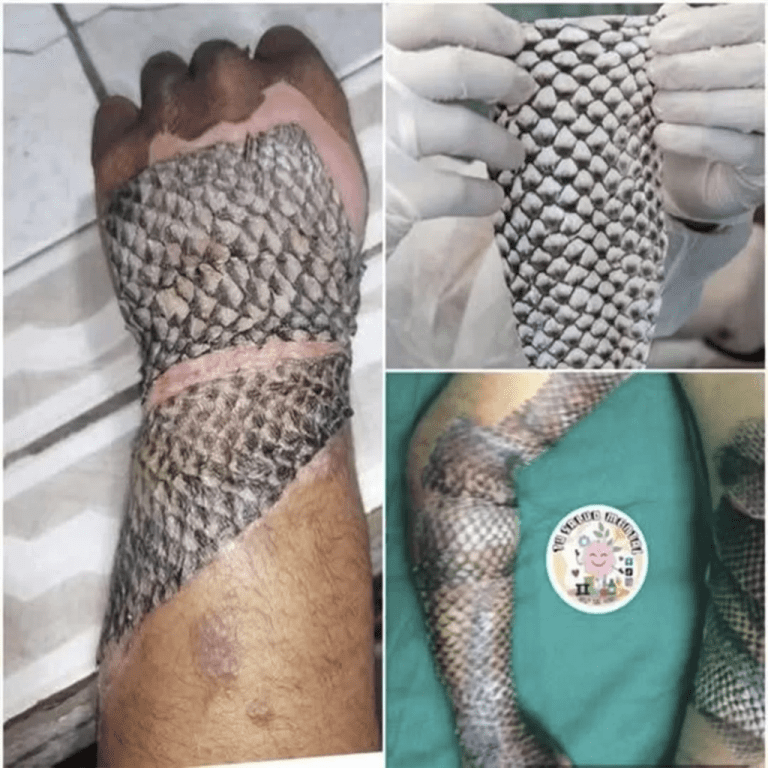 Tilapia Skin: An Innovative Alternative for Burn Recovery - Amazing